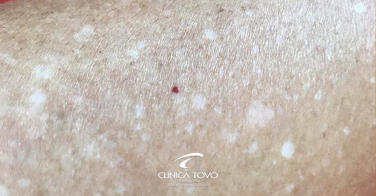 Leucodermia Puntata - Sardas Brancas - Clinica tovo dermatologia dr tovo