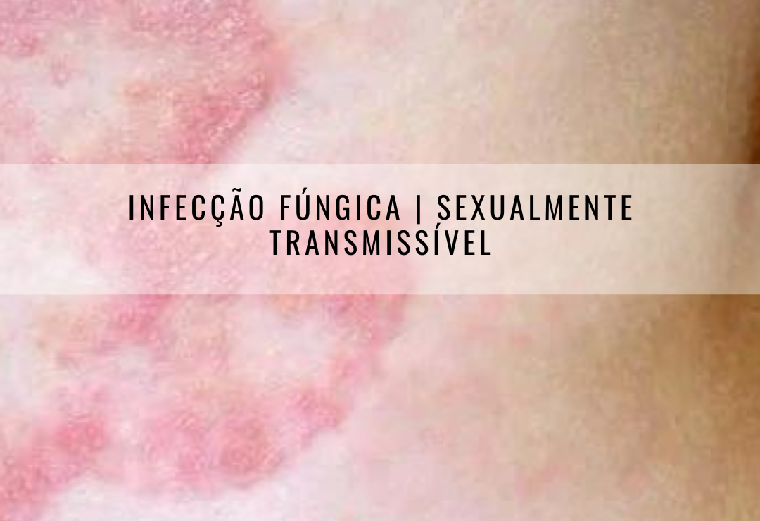 Erupcao Cutanea Com Infeccao Por Fungos Genitais